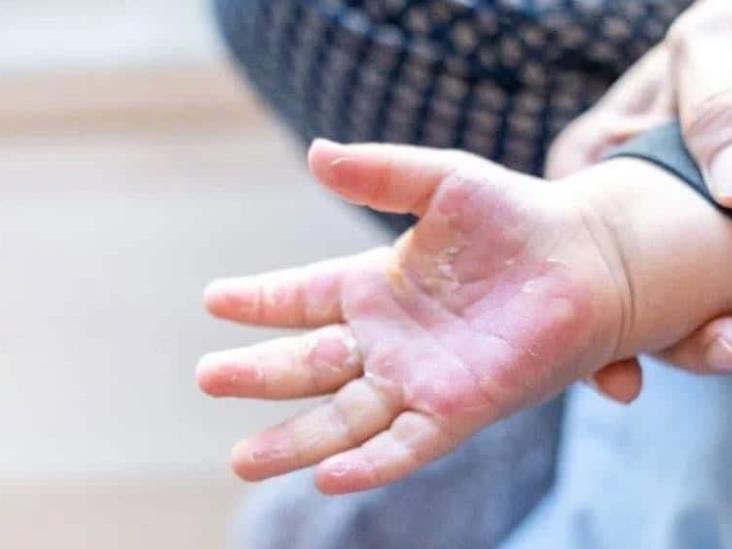 60% de las quemaduras en bebés son por líquidos calientes